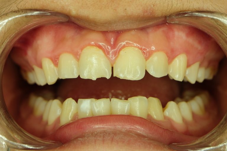 Help I’ve Cracked My Front Tooth! Now What? | Emergency Dentist Manchester